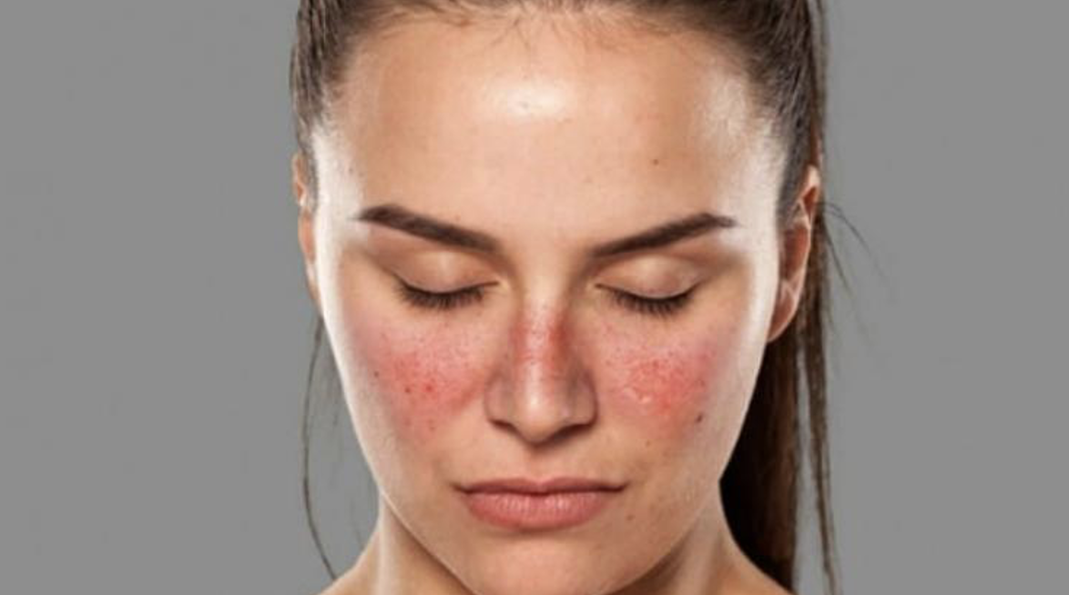 Hidroxicloroquina, principal fármaco para el tratamiento del LES a ...